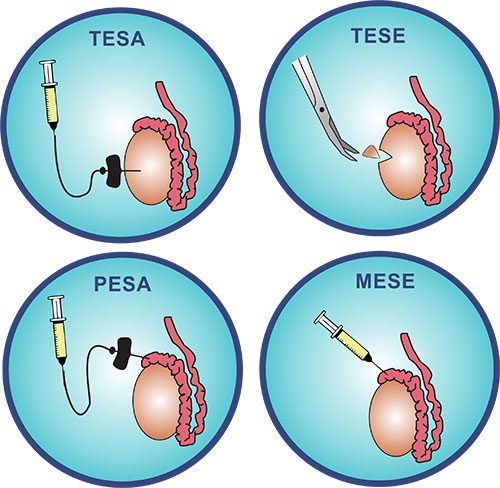 Surgical Sperm Retrieval and Azoospermia - Mcurefertility